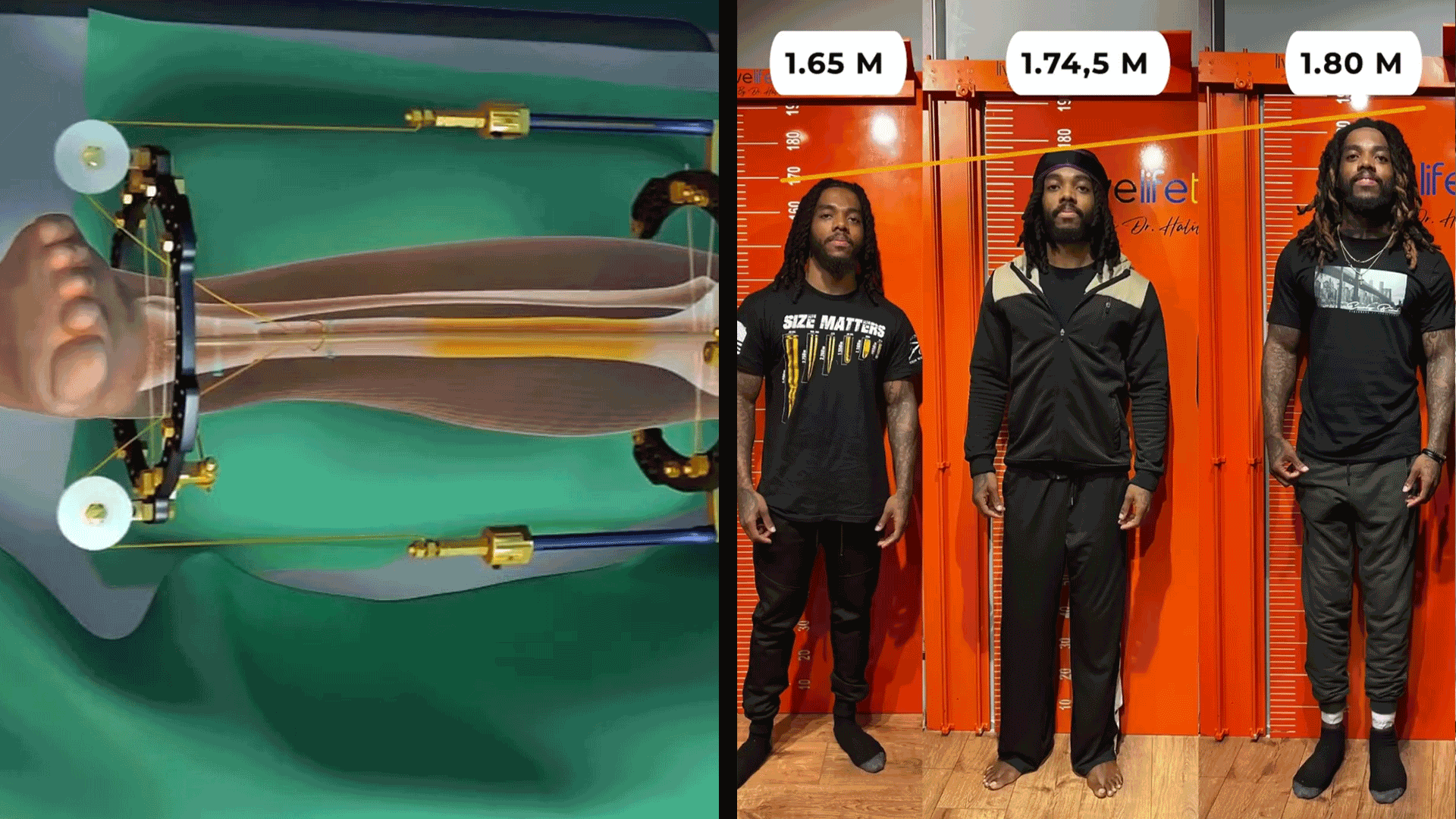 Man Who Underwent Leg Lengthening Surgery Reveals Progress